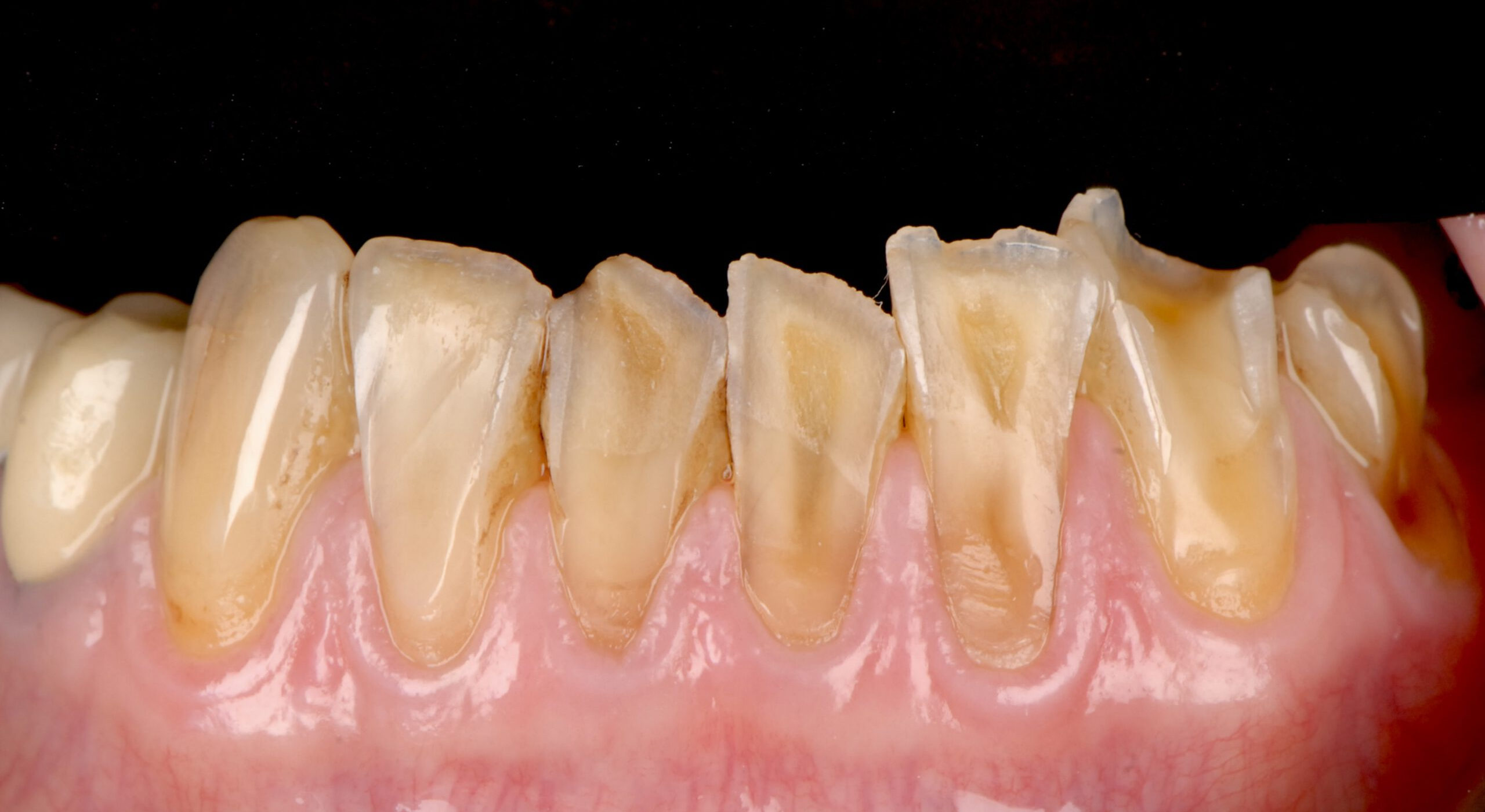 Technika flow injection - Master Level - DenCo - kursy stomatologiczne ...